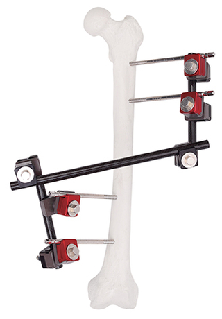 Jinlu Medical orthopedic bone fracture universal pin/rod to rod ...