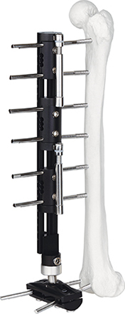 The most reliable orthopaedic implants, locking plates - JINLU